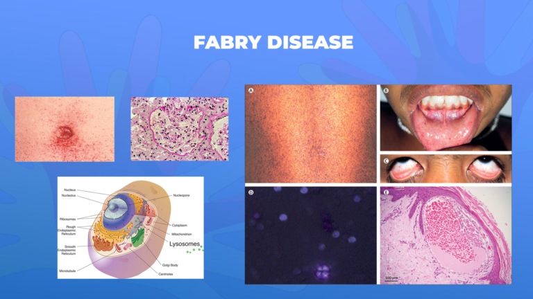 JU NJOFTOJMË ME SËMUNDJET E RRALLA: SËMUNDJA FABRI - Сакам Да Кажам