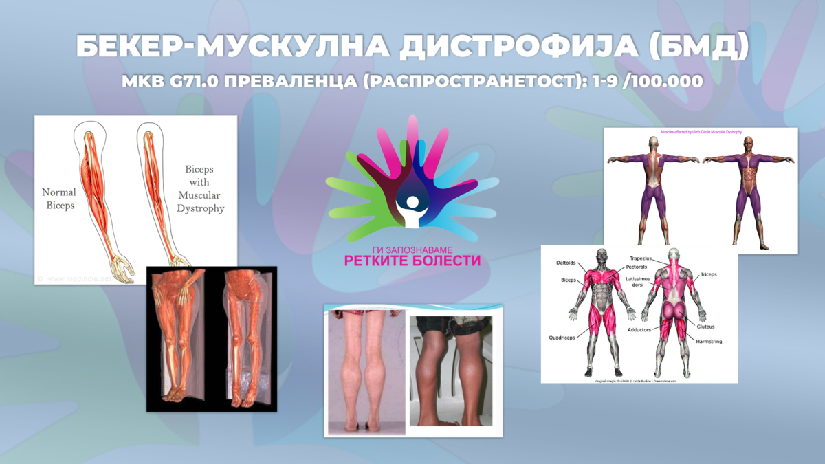 JU NJOFTOJMË ME SËMUNDJET E RRALLA: DISTROFIA MUSKULARE BECKER - Сакам ...