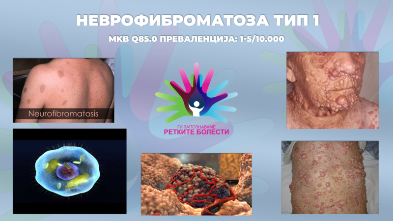 Ju NjoftojmË Me SËmundjet E Rralla Neurofribromatoza Tip 1 Сакам Да Кажам
