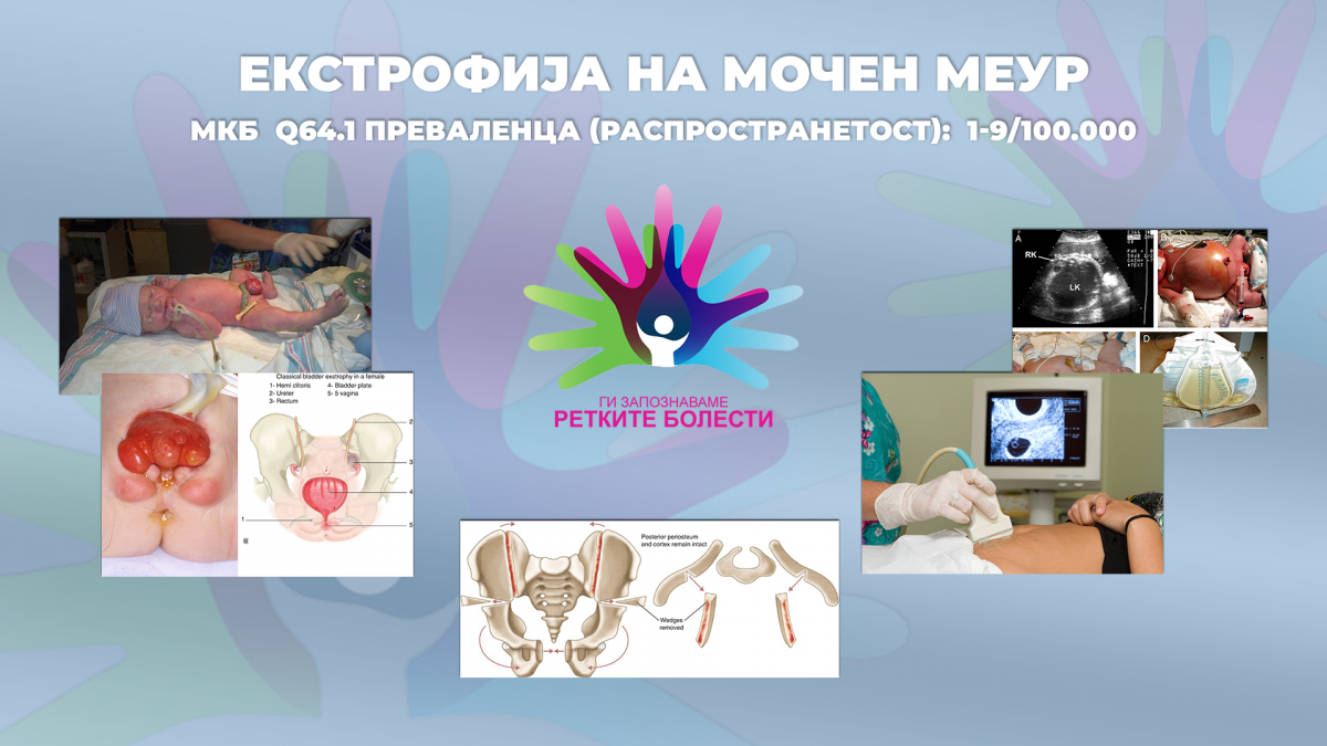 ГИ ЗАПОЗНАВАМЕ РЕТКИТЕ БОЛЕСТИ: ЕКСТРОФИЈА НА МОЧЕН МЕУР - Сакам Да Кажам